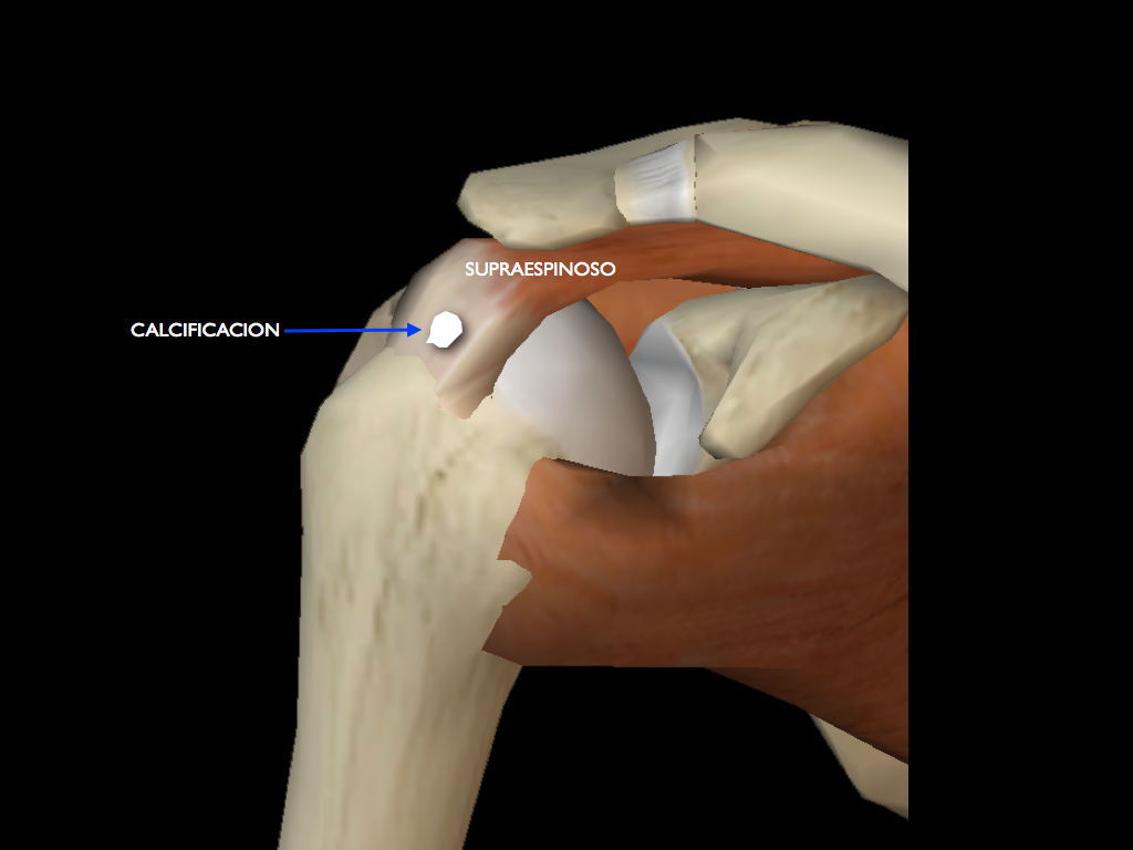 Calcificaciones Qué Son Y Cómo Puede Ayudarte La Fisioterapia Fisio